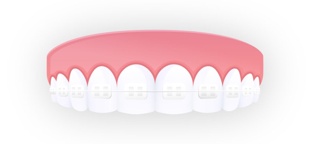 Clear Braces in Taylorsville, UT | Orthodontic Treatment