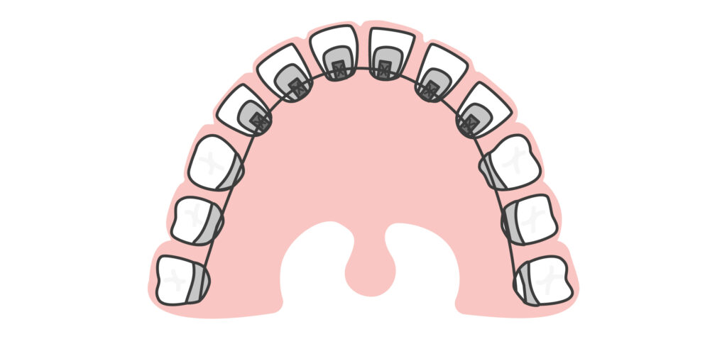 Traditional Braces in Taylorsville, UT | Hillstead Orthodontics